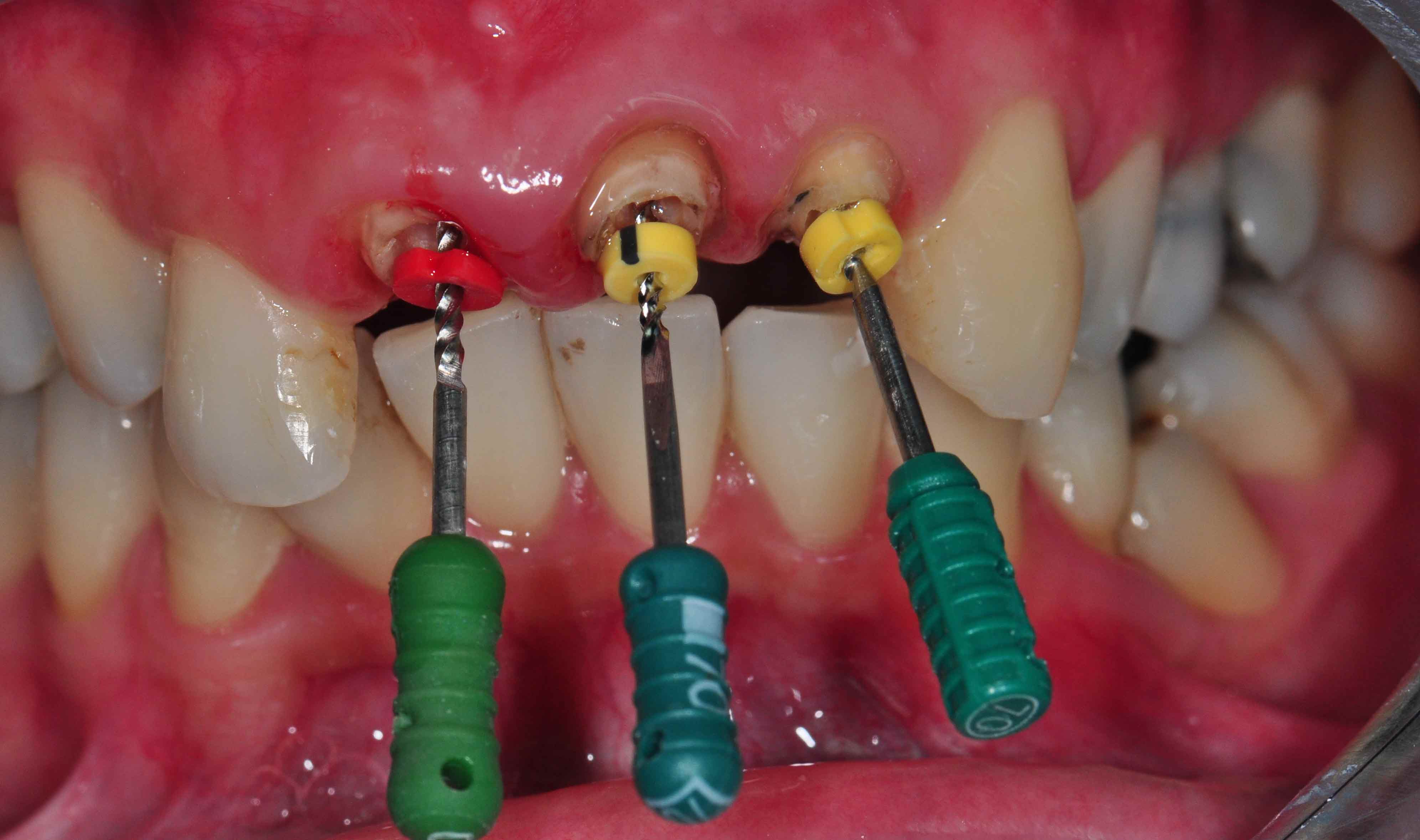 Front Tooth Root Canal Front Tooth Root Canal