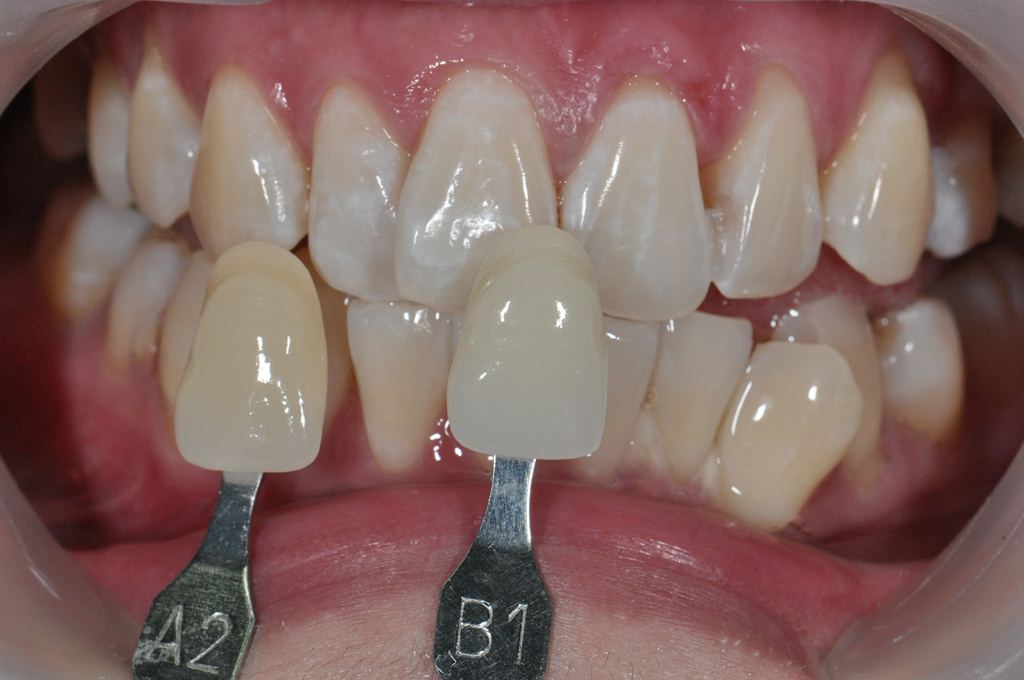 Tooth Color Chart B1 Infoupdate Tooth Color Chart B1 Infoupdate